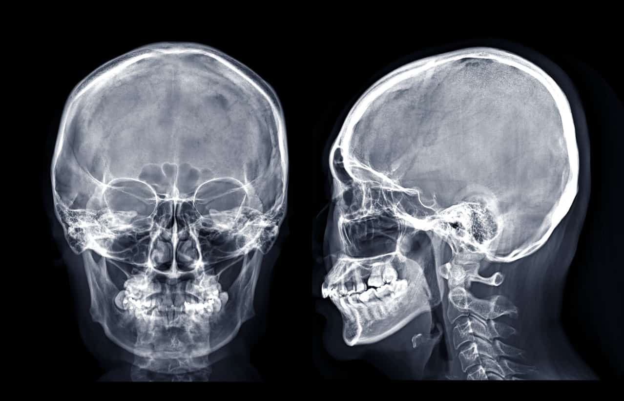 Do Dermal Fillers Show Up On X-Rays? - Digital Health Buzz!