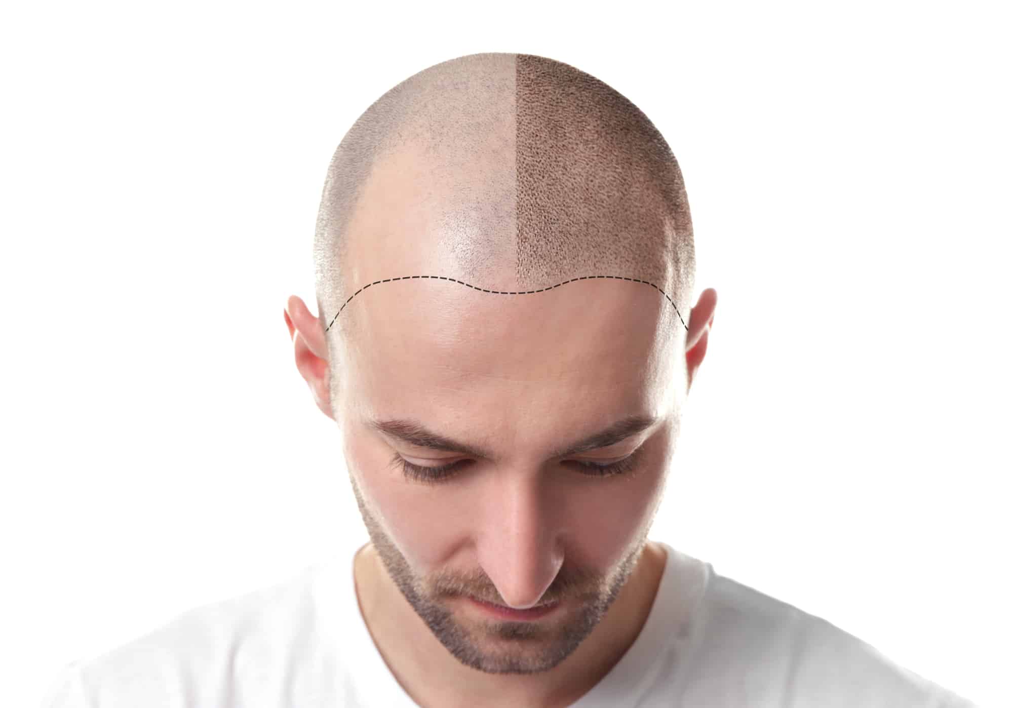 Benefits of Getting Scalp Micropigmentation - Digital Health Buzz!